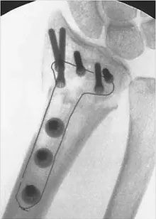 CarboFix - "Piccolo" Distal Radius Plates - Ortospine