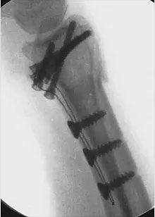 CarboFix - "Piccolo" Distal Radius Plates - Ortospine