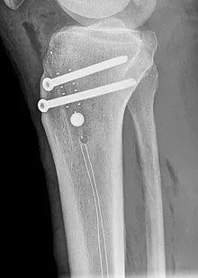 CarboFix "Piccolo" Tibia Nails - Ortospine